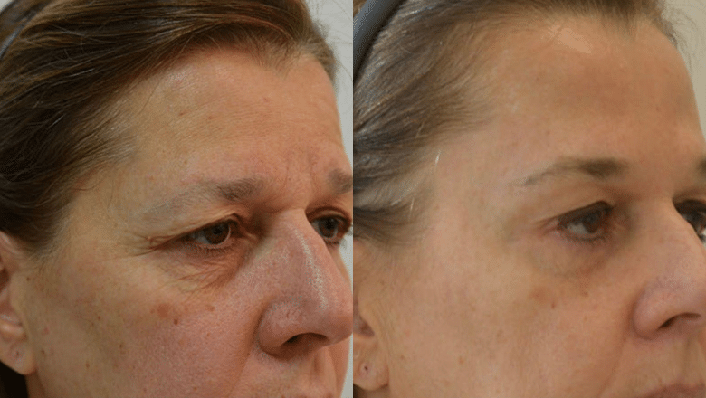 Trifecta Lift: The Threefold Approach to Replacement, Restoration and ...