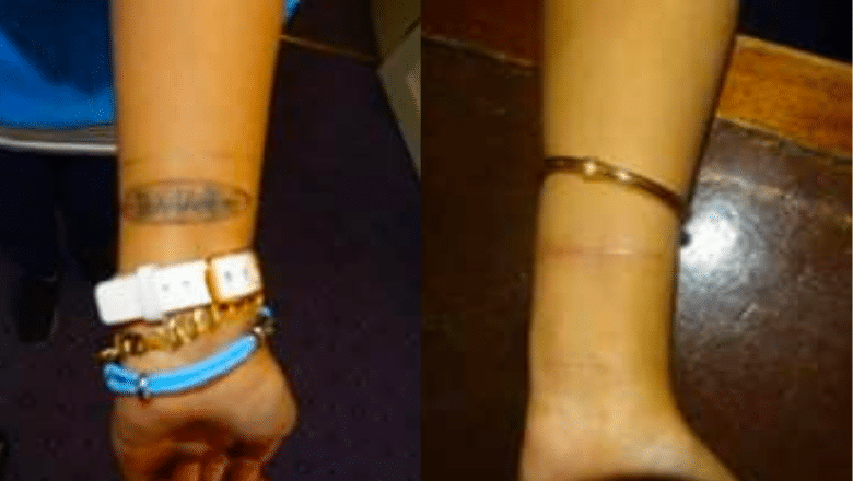 Surgical Tattoo Removal London | Tattoo Excision UK | Centre for Surgery