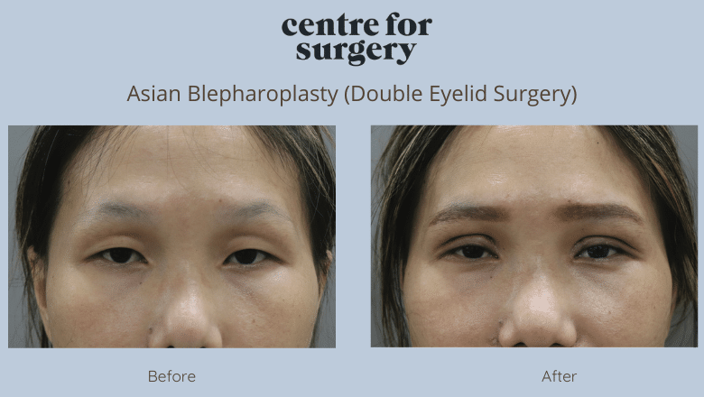 Asian Blepharoplasty London | Double Eyelid Surgery UK