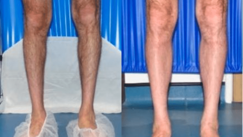 Calf Augmentation Before & After Photos | Centre for Surgery