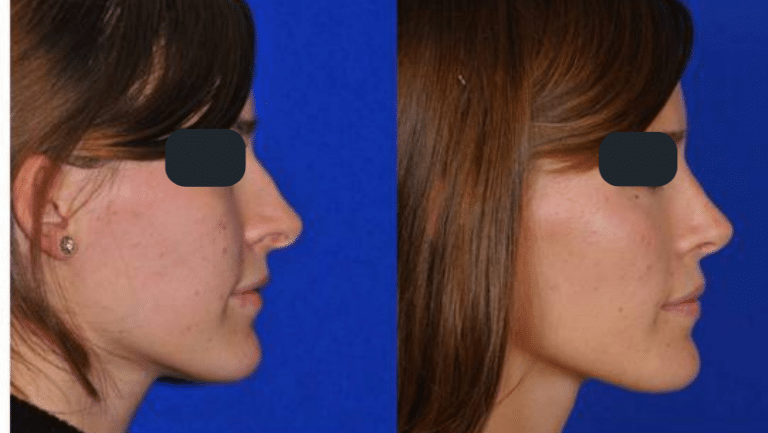 Rhinoplasty Before & After Photos | Centre for Surgery